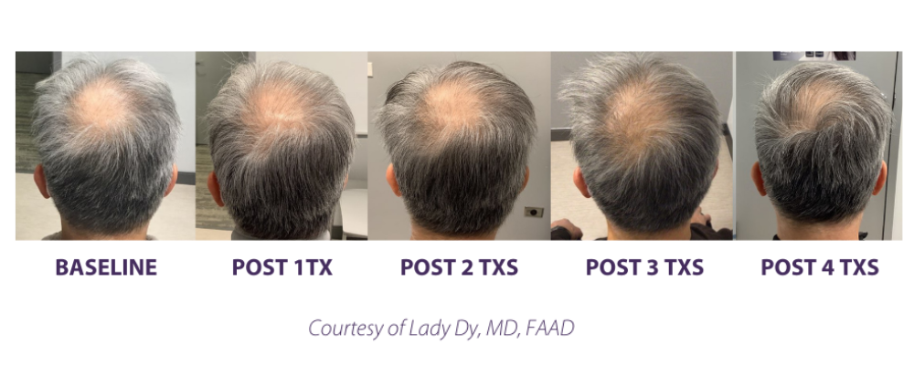 Alma TED Hair Restoration - Northshore Rejuvenation