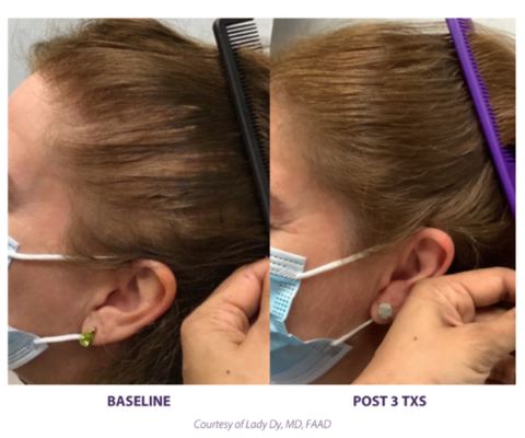 Alma TED Hair Restoration - Northshore Rejuvenation