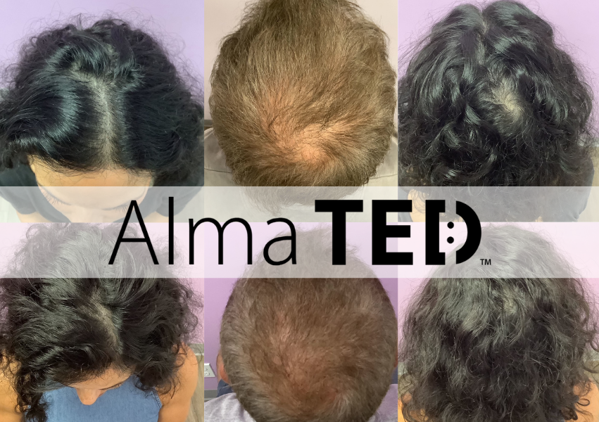 Alma TED Hair Restoration - Northshore Rejuvenation